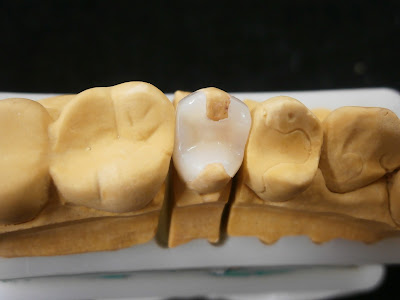 髙田朝（Hajime Takada）のオーダーメイド歯科技工物の紹介 Introduction of custom-made dental ...