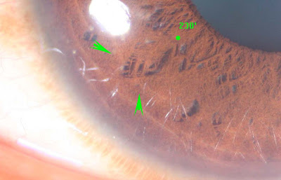 Modern & Multidimensional Iridology: Contraction Furrows Intersect ...