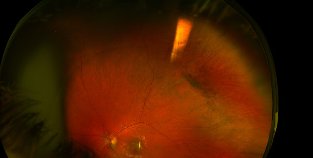 Sonoran Desert Eye Center: COMMOTIO RETINAE WITH VITREOUS HEMORRHAGE
