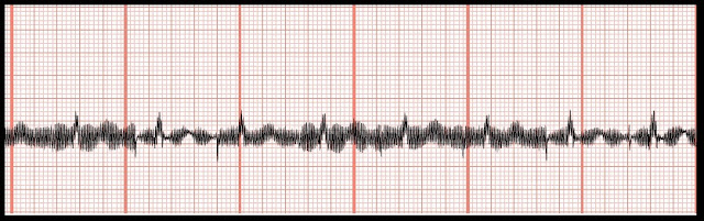 Float Nurse: Practice EKG Rhythm Strips 158