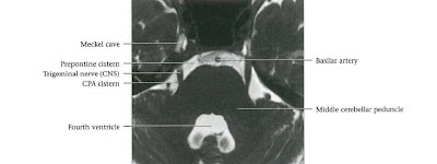 Dr Balaji Anvekar FRCR: Cranial Nerves Normal MRI Anatomy