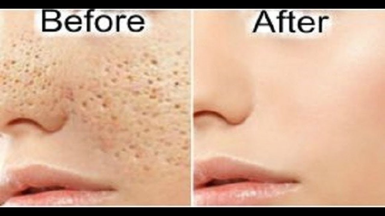 How to Reduce Pore Size - TOP 5 DIY