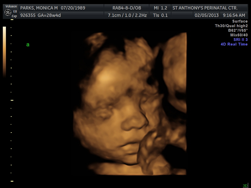 A Walk in the Parks with 65 Roses: 28 Week Twin Update and Ultrasound Pics