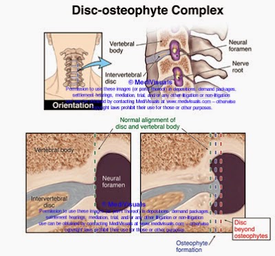 The Medical Legal Exhibit Expert Blog: Disc-Osteophyte Complex Explained