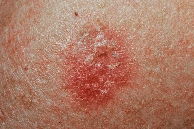 Kanker Kulit: Pengertian Kanker Kulit ~ Tips Perawatan Dan Kesehatan Kulit