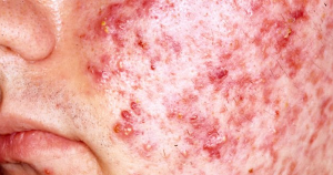 Jerman Imports: ACNE: Causas e tratamento