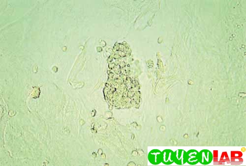 Atlas of Casts in urine | Free Medical Atlas