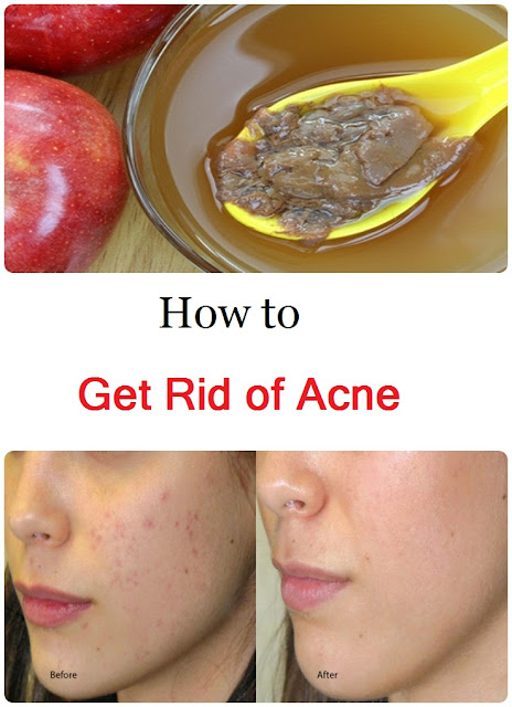 How to Get Rid of Acne - TOP 5 DIY