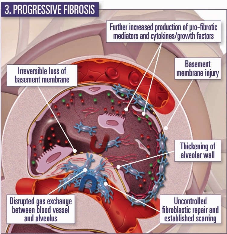 Pulmonary Fibrosis for a 4th Grader: Pathophysiology of Pulmonary Fibrosis