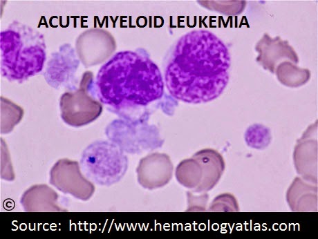 Lab Atlas: Acute Myeloid Leukemia