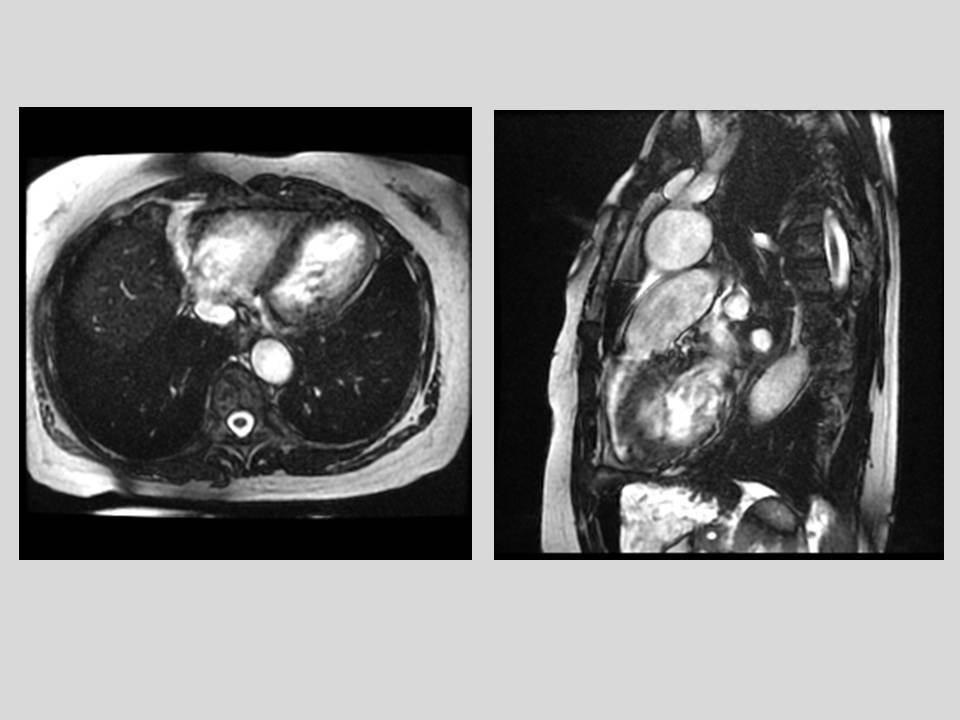 The Pump and the Tubes: Maximum fluid intensity -- bSSFP MRA