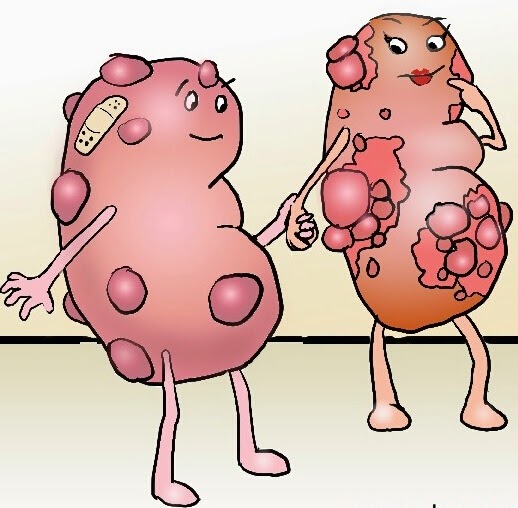 Trattamento della malattia renale: Rene policistico è che tipo di malattia?