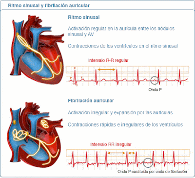 Fisioterapia Cardiorrespiratoria: Equipo 5: Ritmos Variables