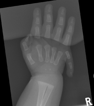 Extra Digits | Congenital Hand and Arm Differences | Washington ...