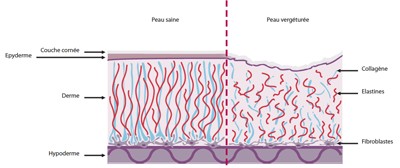 A l'adolescence, comment et pourquoi les vergetures apparaissent