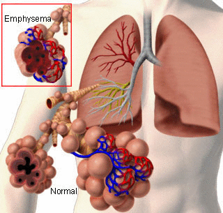 Signs of emphysema | Signs of emphysema