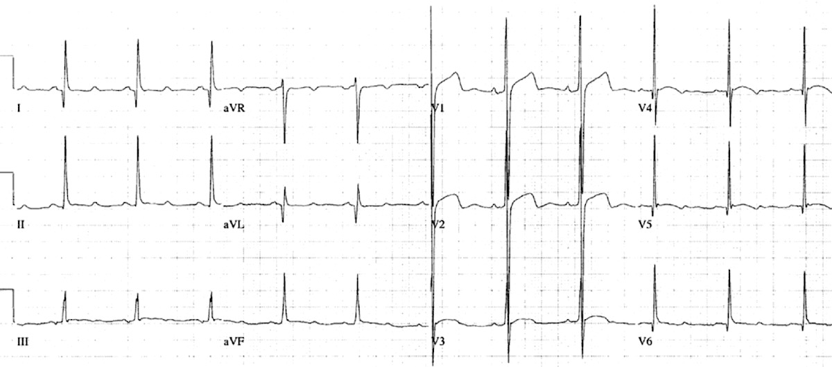 Dr. Smith's ECG Blog: 15 yo AAM with ST Elevation and T-wave Inversion ...