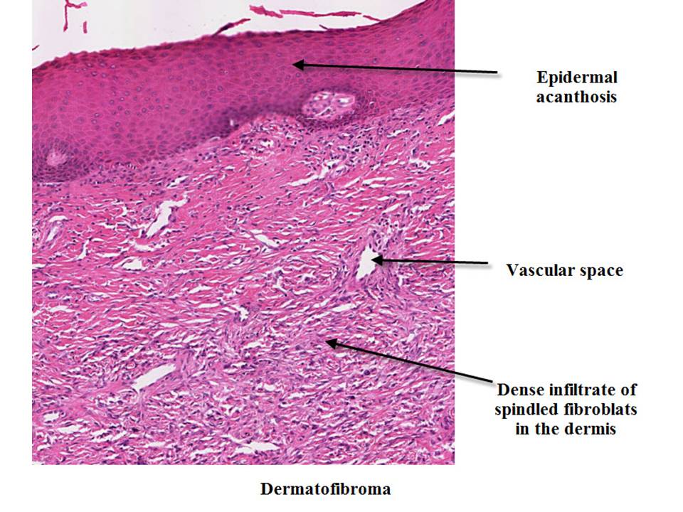Dermpath Made Simple - Neoplastic: Dermatofibroma