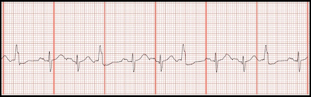 Practice EKG Rhythm Strips 158