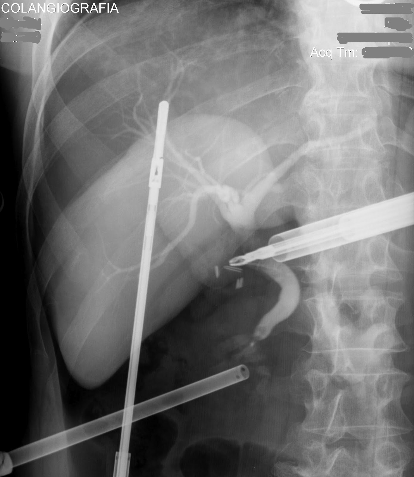 O Radiologista: Coledocolitíase - Colangiografia