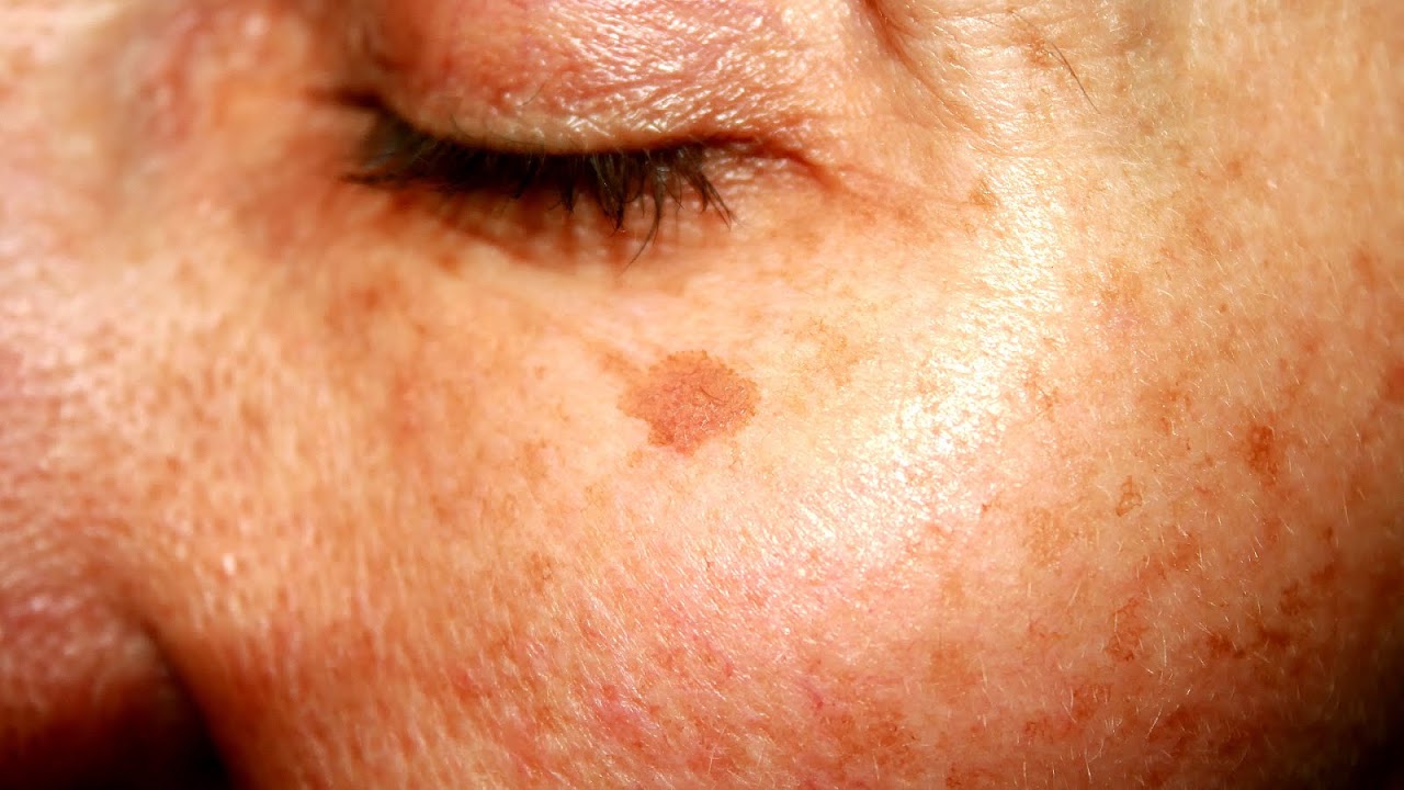 Café au lait spot Danger - Danger Choices