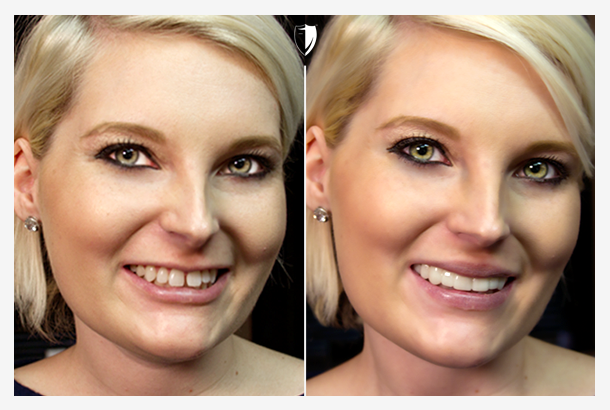 With Five Questions: Introducing Press On Veneers™ by Brighter Image Lab