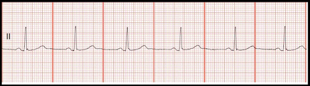 Practice EKG Rhythm Strips 145