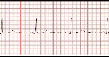 Float Nurse: Practice EKG Rhythm Strips 145