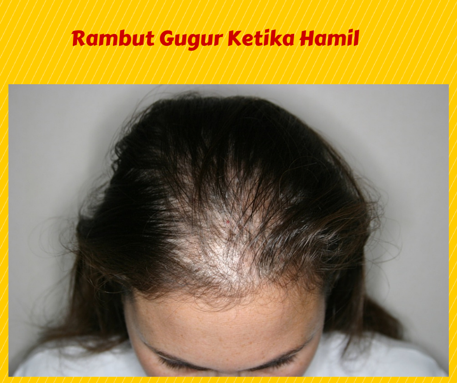 MASALAH RAMBUT GUGUR