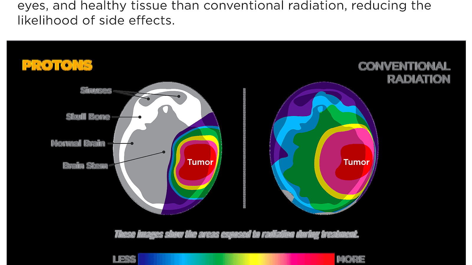 Proton Radiation Side Effects Effect Choices