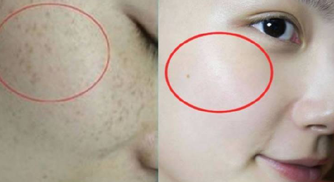 Gadis Ini Mengoleskan "Bahan Ini" Di Wajahnya Yang Di Tumbuhi Bercak ...