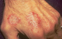 Skin And Facial Treatments: Eczema