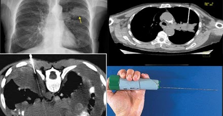 CT Scan Guided Procedures : Biopsies, Drainage & Needle Placement Technique - RadTechOnDuty