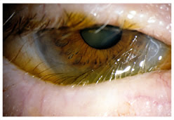 Healthy: Entropion, Diagnosis dan Tatalaksana