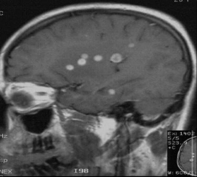 MRI MEDIC CASE STUDIES COLLECTION: BRAIN AND SPINAL CORD LESIONS ...