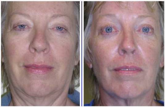 Facial Development Newsletter: THE SCIENCE BEHIND THE HOMEOBLOCK™ APPLIANCE