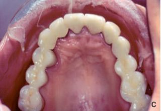 bridge dentaire de contention