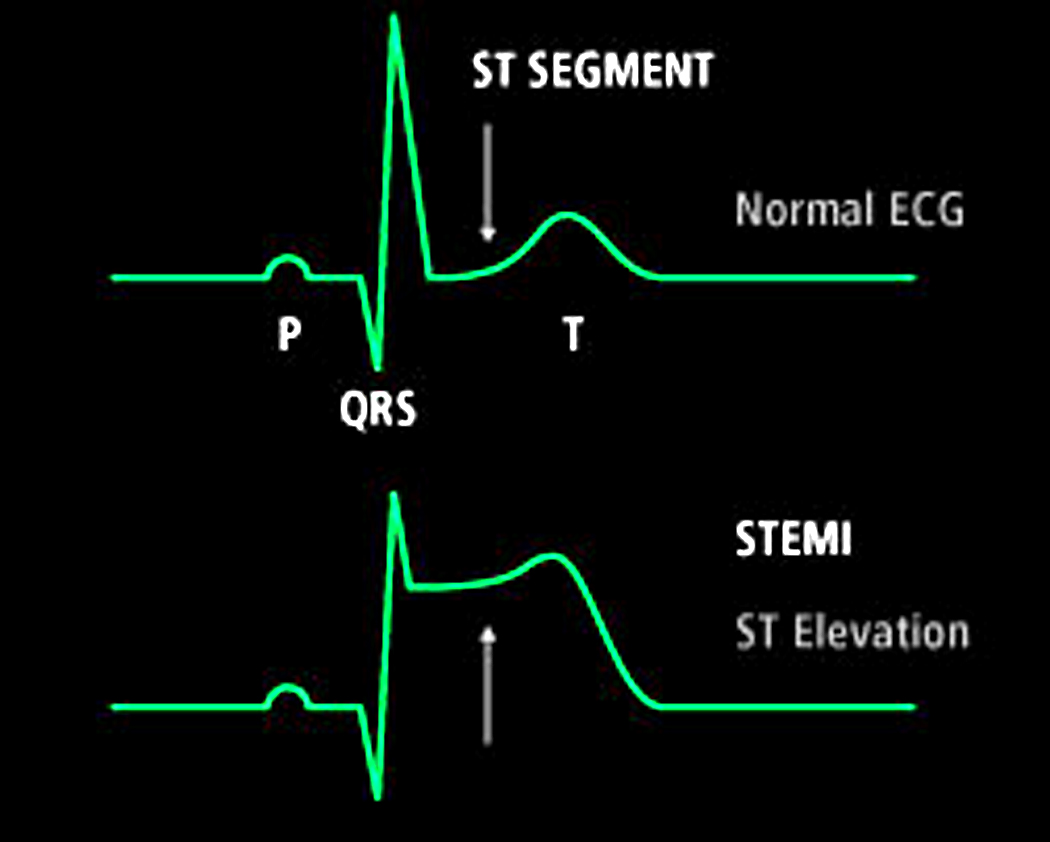 STEMI ( Infark Miokard Dengan ST Elevasi ) | INA - ECG