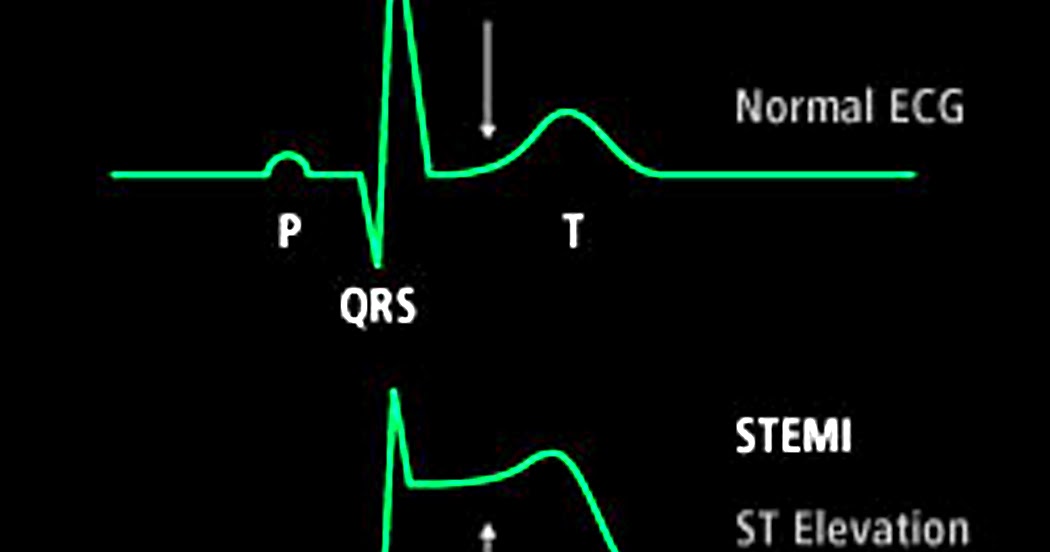 STEMI ( Infark Miokard Dengan ST Elevasi ) | INA - ECG