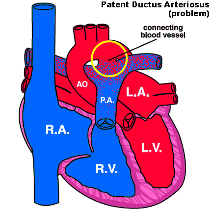 NURSING CARE: Patent Ductus Arteriosus (PDA)