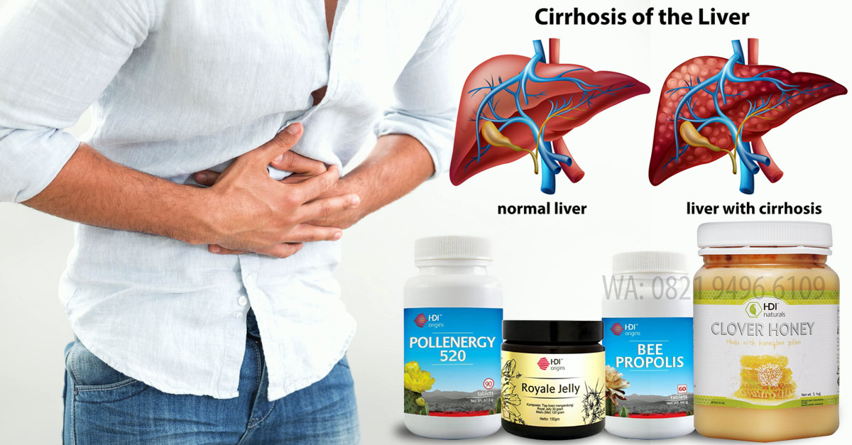 Sirosis Hati | Madu Asli - High Desert