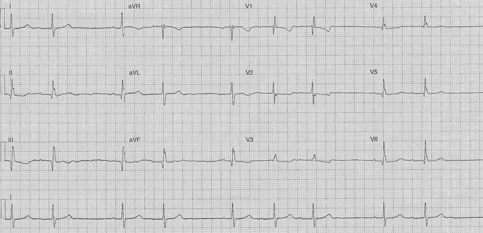 ECG of the Week: ECG of the Week - 22nd September 2014 - Interpretation
