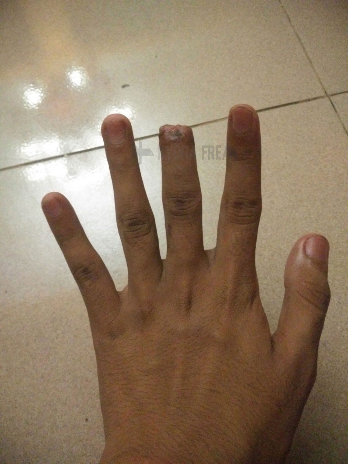 Pengalaman Amputasi Satu Ruas Jari Tengah Tangan Kiri • hydra-F