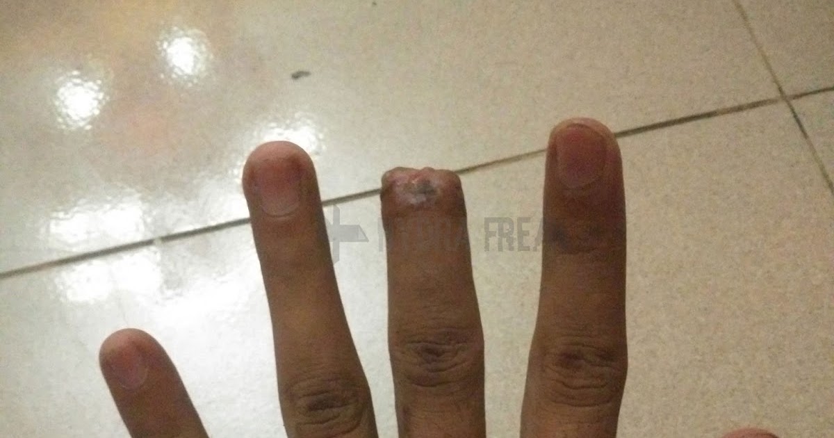 Pengalaman Amputasi Satu Ruas Jari Tengah Tangan Kiri • hydra-F