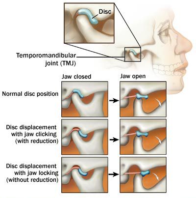 About Health: Temporomandibular joint syndrome