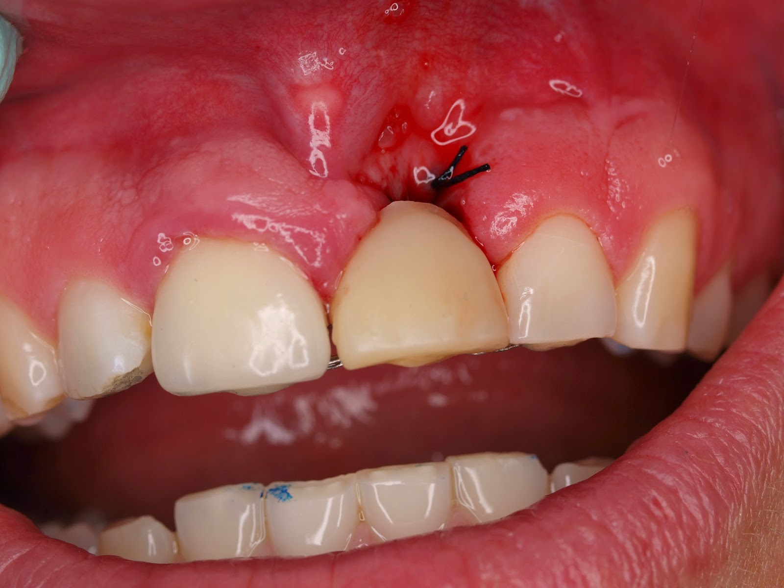 Notas de Odontología: Injerto en bloque de menton fase 1:extracción del ...