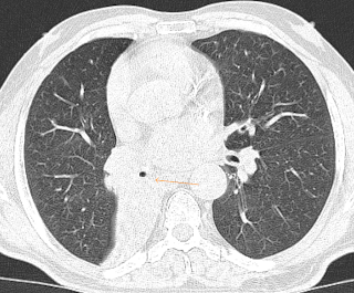 Resident's Miss RLL Collapse-Exam Case - Sumer's Radiology Blog