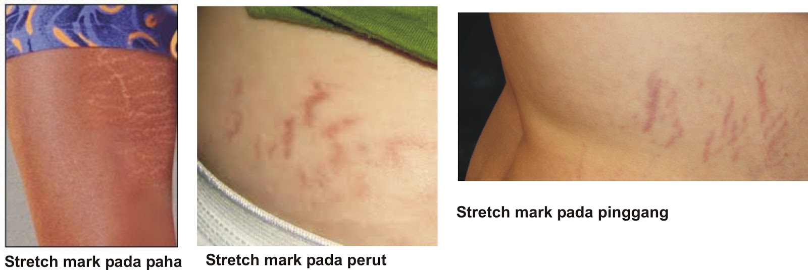 IBU CERDAS: Tips cara mengatasi stretch mark