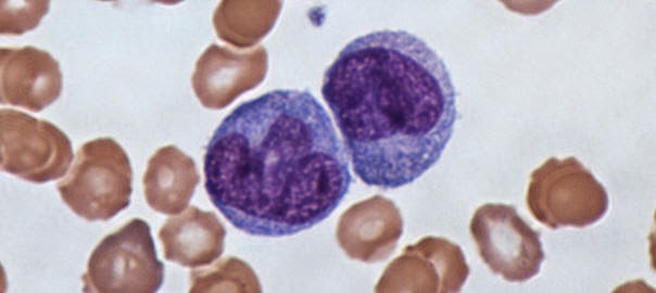 FICHERO DE HEMATOLOGÍA: ANORMALIDADES LEUCOCITARIAS. Cambios en el ...