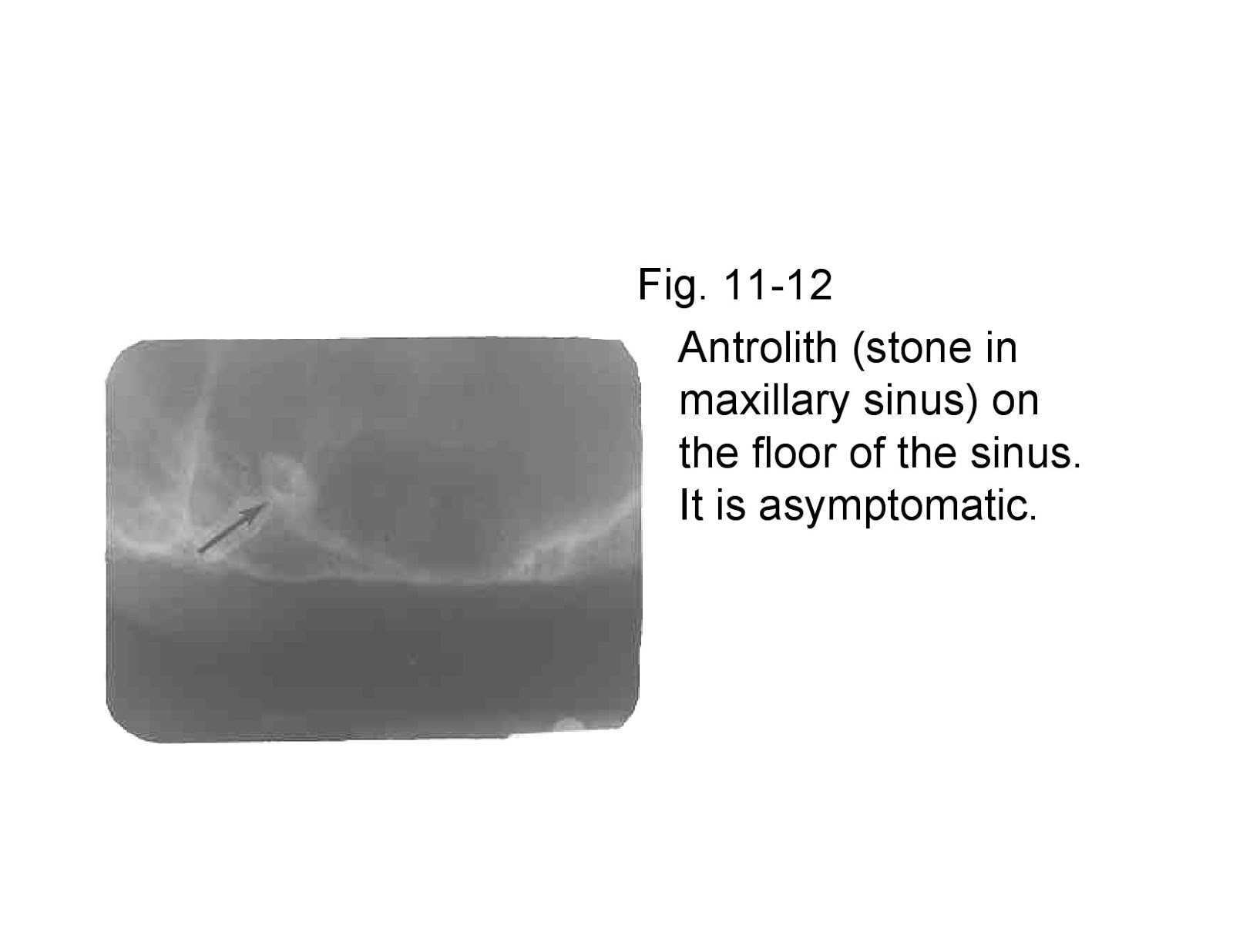Dentistry and Medicine: SOFT TISSUE CALCIFICATIONS IN ORO-MAXILLO ...